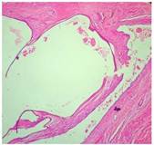 Figure E: Microphotograph showing multiloculated cyst (H & E X40)